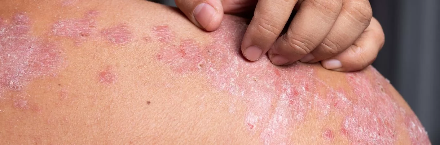 Eczéma : Comment améliorer naturellement un terrain atopique ...